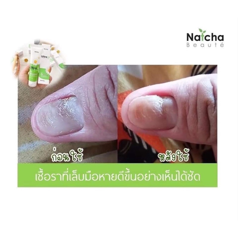 เซ็ท 6 หลอด แถมสบู่แก้เชื้อรา 1 ก้อน อัลตร้ายูครีม ของแท้ ส่งฟรี Natcha ...