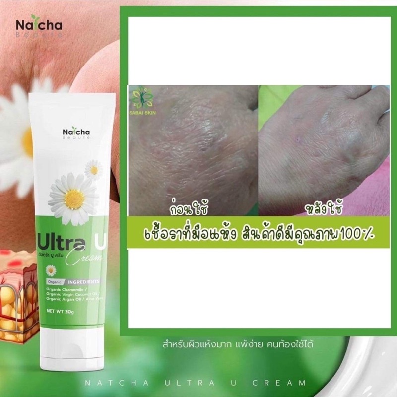 อัลตร้ายูครีม เซ็ท 6 หลอด แถมฟรี สบู่แก้เชื้อรา 1 ก้อน ของแท้ ส่งฟรี Natcha Ultra U Cream ...
