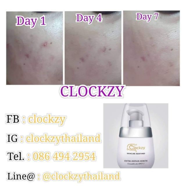 เซรั่ม ลดรอยสิว (1แถม1สุดคุ้ม) ลดริ้วรอย หน้าใส หน้าดูอ่อนวัย ลดริ้วรอย รอยแดง รอยตีนกา แท้ (By ...