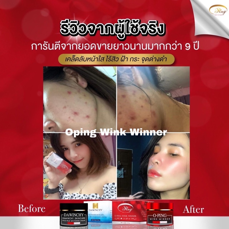 ครีมลดสิว หน้าใส โอปิ๊ง สูตรเก่าดั้งเดิม (O-Ping Wink Winner ...