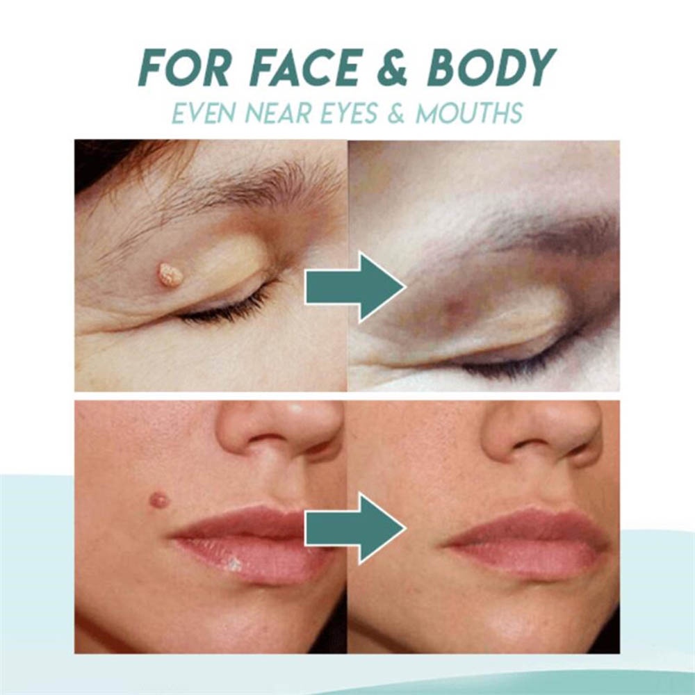 1Bag Skin Tag Remover Patch Ance Pimple Patch Plaster Acne Cream ...