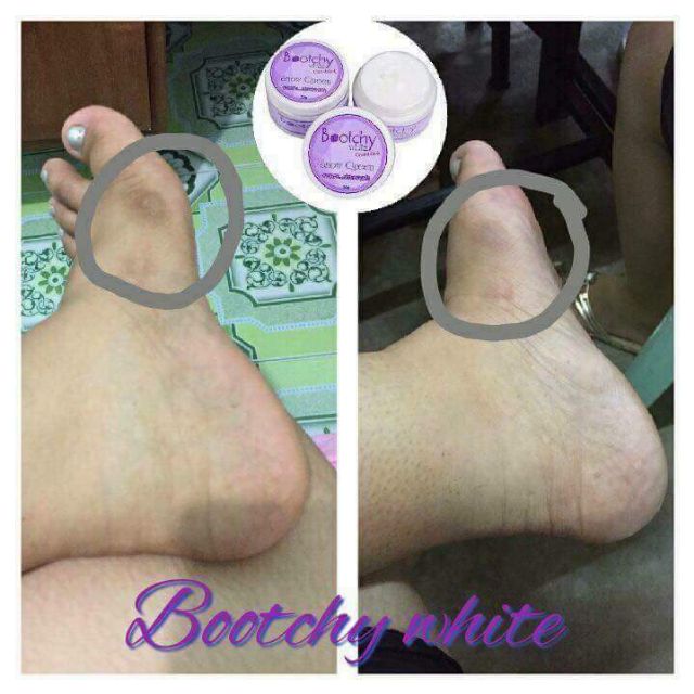 ครีมแก้ท้องลาย แก้ก้นดำ แก้รักแร้ดำ Bootchy White 10 กระปุก พร้อมส่งฟรีไปเลยจ้า - bootchy_white ...