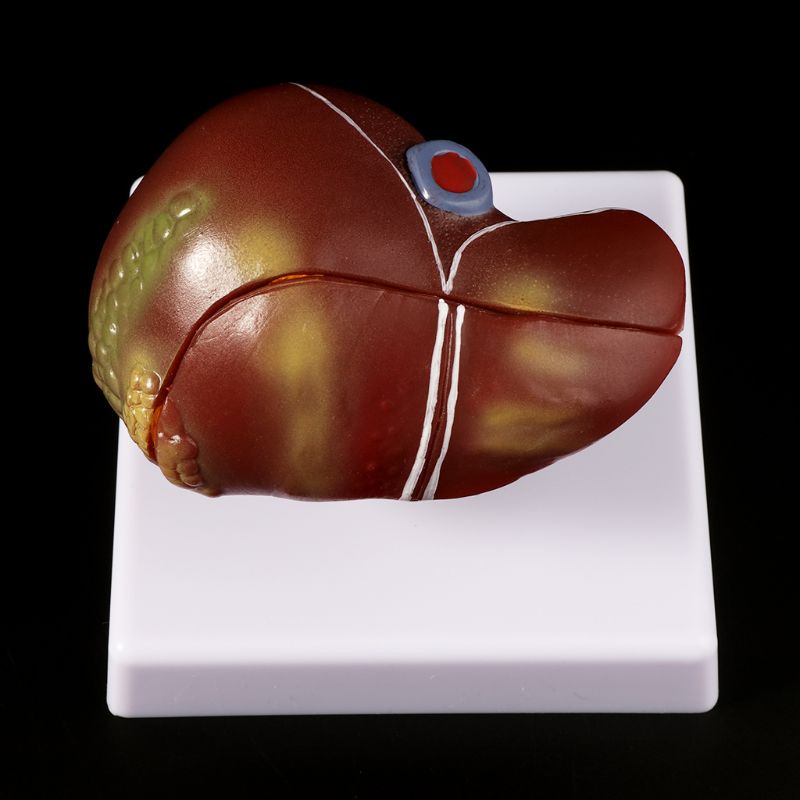 GOO Human Liver Pathological Anatomical Model Anatomy School Medical ...