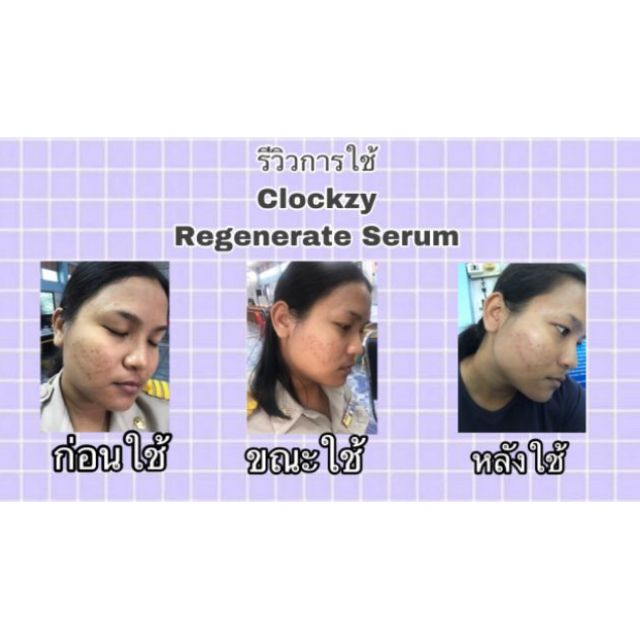 เซรั่ม ลดรอยสิว (1แถม1สุดคุ้ม) ลดริ้วรอย หน้าใส หน้าดูอ่อนวัย ลดริ้วรอย รอยแดง รอยตีนกา แท้ (By ...