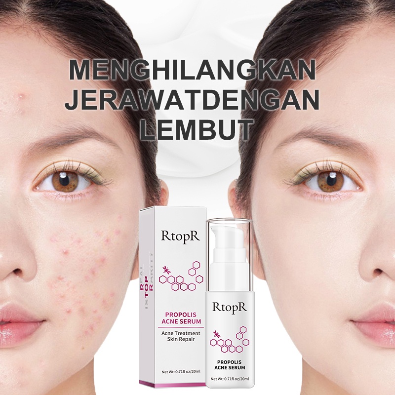 RtopR เซรั่มลดสิว เผยผิวกระจ่างใส บอกลาปัญหาสิว สูตรช่วยลดสิวและควบคุม ...