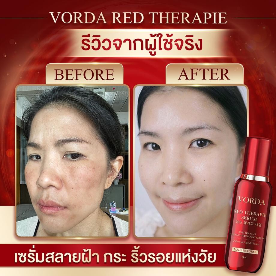 3แถม 2 เซรั่มฝ้า วอร์ด้า ดิวอริสา แท้ Vorda Red Therapie Serum เซรั่มจักรพรรดิ ลดฝ้า กระ จุดด่าง ...