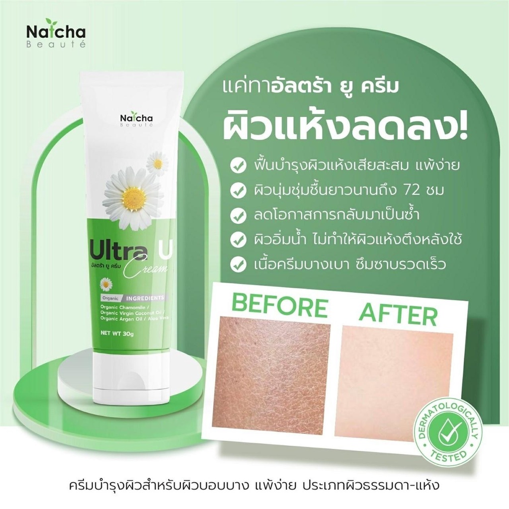 ครีมทาผิวหนังอักเสบ เชื้อรา สะเก็ดเงิน ครีมสำหรับใช้ภายนอก ครีมอัลตร้ายู Ultra U 1 หลอด 30 กรัม ...