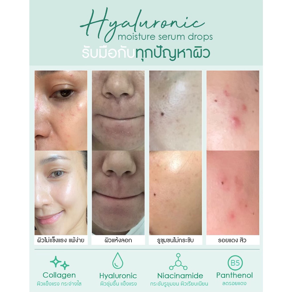 CHO SKIN HYALURONIC MOISTURE SERUM DROPS เซรั่มไฮยาหมอเกาหลี ขนาด 50 ml ...