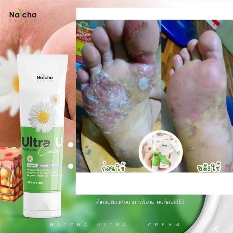 เซ็ท 6 หลอด แถมสบู่แก้เชื้อรา 1 ก้อน อัลตร้ายูครีม ของแท้ ส่งฟรี Natcha Ultra U Cream แก้เชื้อรา ...