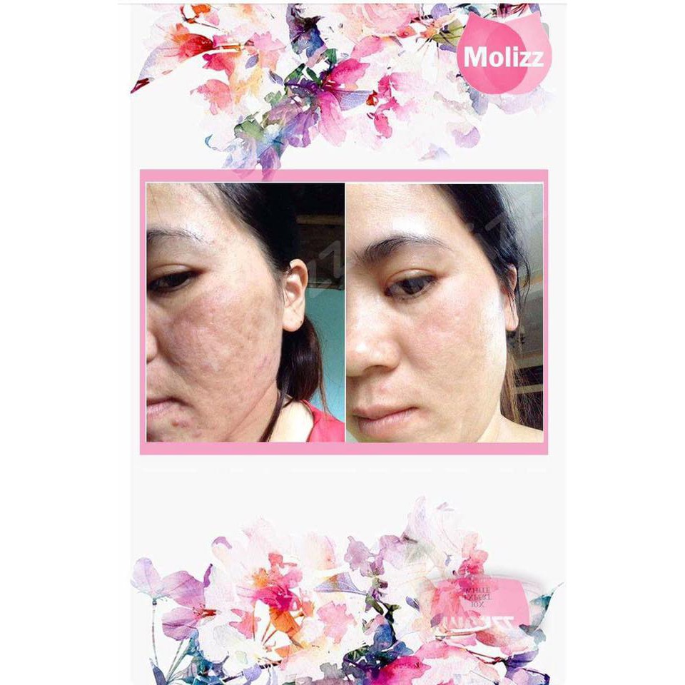 (ของแท้)ครีมทาฝ้า Molizz โมลิส ครีมรักษาฝ้า ขนาด 15 กรัม - prettynarak ...