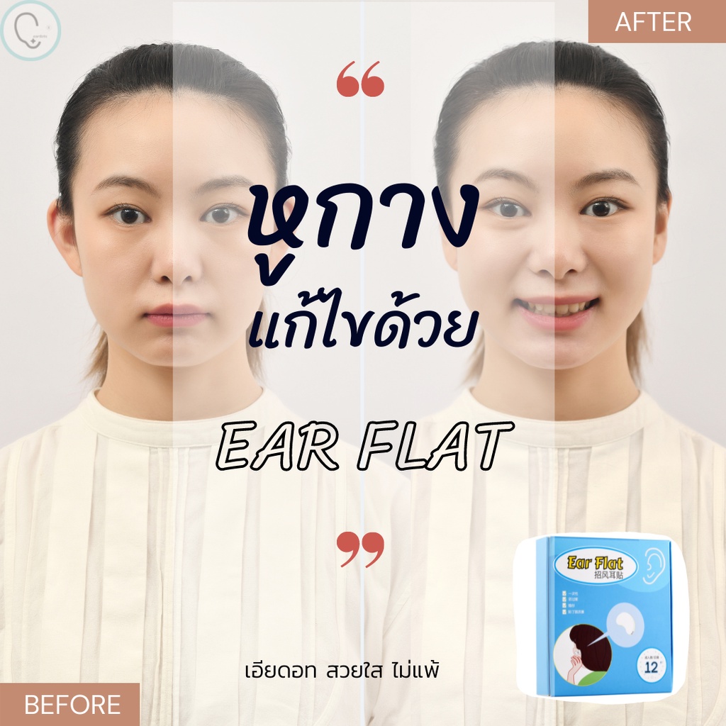 กดติดตามมีส่วนลด แก้ปัญหาหูกางด้วย Ear flat พร้อมส่ง (ตัวแทนจำหน่ายใน ...
