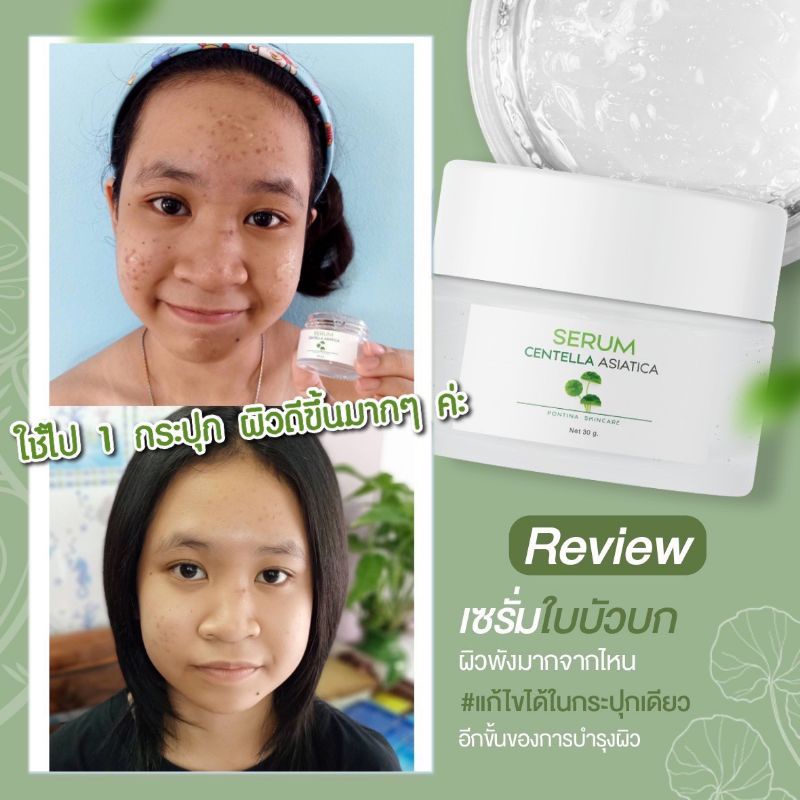 เซรั่มใบบัวบกผสมว่านหางจระเข้ลดสิวใน3วัน - pee.tipfy - ThaiPick