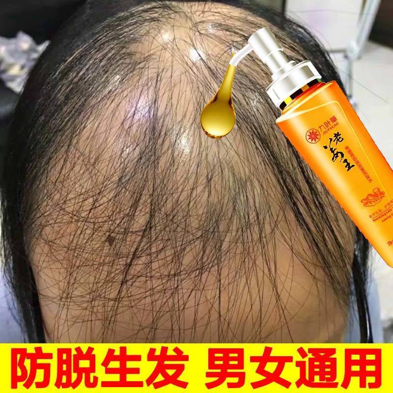 ป้องกันผมร่วง ปลูกผม ผู้ชายและผู้หญิง for ↂแชมพูขิงแก่ขิงแท้จาก Nine ...