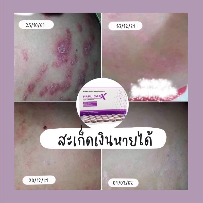 ถูกที่สุดส่งฟรีPRPL CAPXเพอเพิลแคปเอ็กซ์ อาหารเสริมฟื้นฟูเซลล์ ️ของแท้ ...