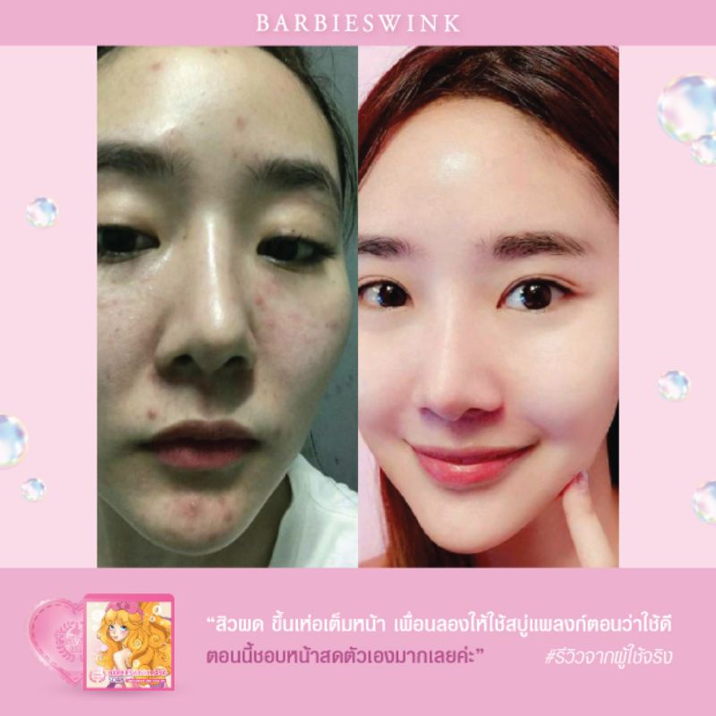 Barbieswink Mask Soap สบู่ล้างหน้าแพลงก์ตอน บาร์บี้วิ้งค์ สบู่มาสก์หน้า ลดสิว หน้าใส - the.one ...