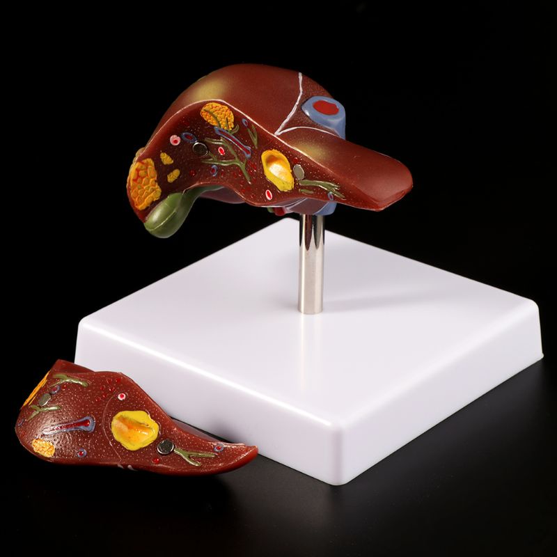 GOO Human Liver Pathological Anatomical Model Anatomy School Medical ...