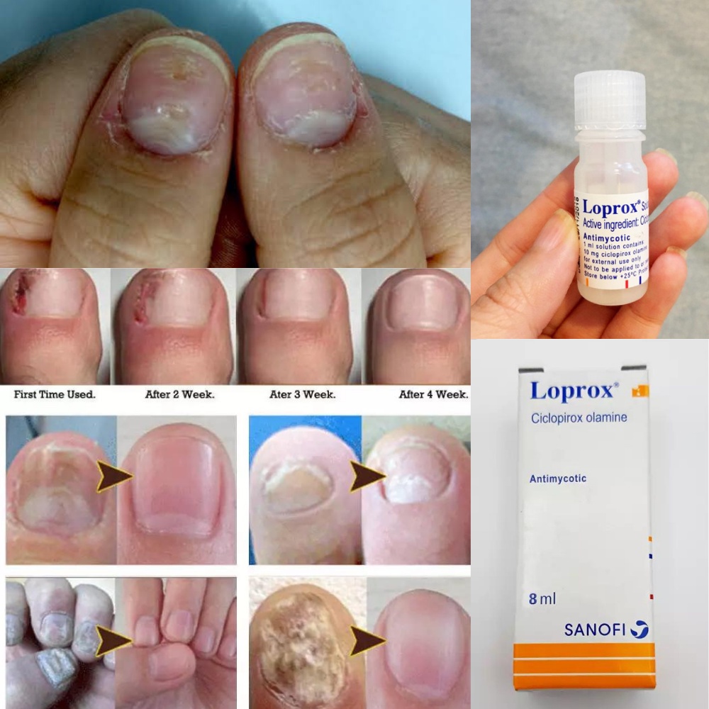 💥ขายดี💥 loprox 8ml โลพรอกซ์(1กล่อง)ของแท้ เห็นผล100% รักษาเชื้อราเล็บ ...