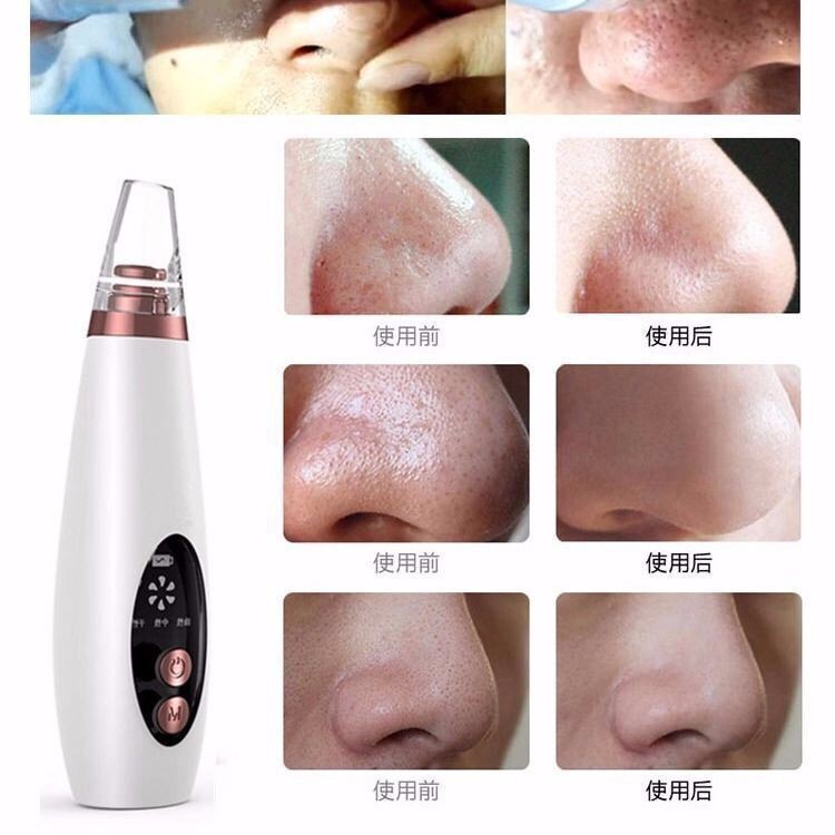 เครื่องมือทำความสะอาดไฟฟ้า☇ↂBlackheads Artifact Absorbing Apparatus ...