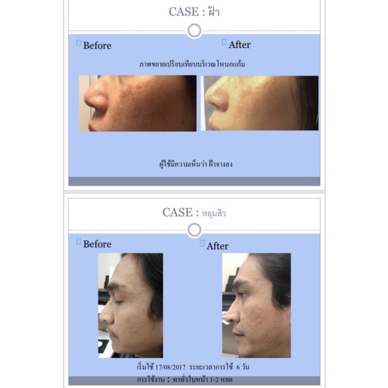 เซรั่มเมือกหอยทากอาช่า (Acha snail filtrate serum) - tttitee - ThaiPick