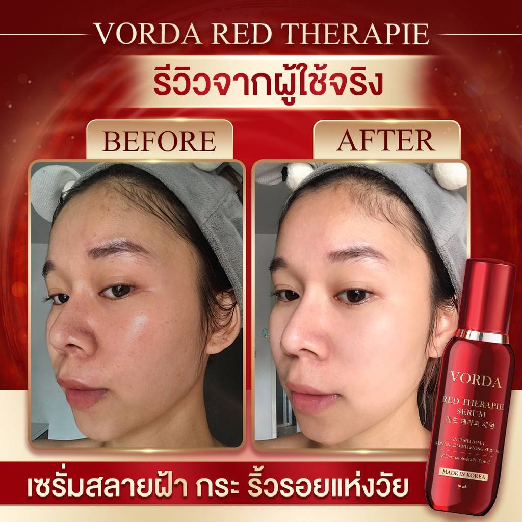 1 แถม 1 Vorda RedTherapie Serum️เซรั่มดิวอริสรา นำเข้าจากเกาหลี หน้าใส ลดเลือนฝ้า กระ จุดด่างดำ ...