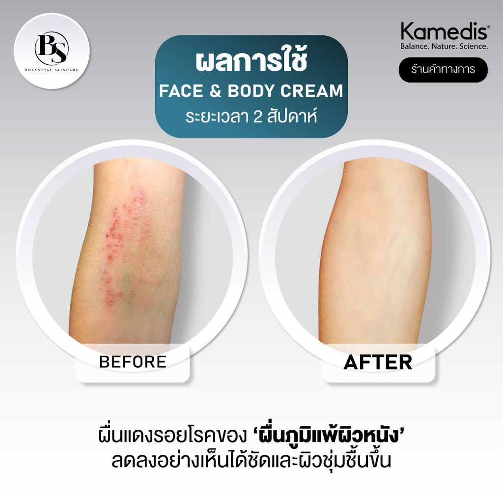 มอยเจอร์ไรเซอร์ครีมสำหรับผิวแห้งลอกคัน ผื่นภูมิแพ้ผิวหนัง Kamedis Topic ...