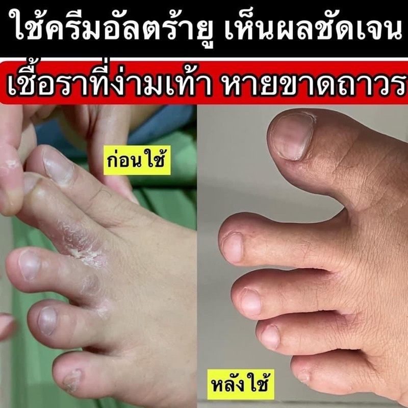 อัลตร้ายูครีม เซ็ท 3 หลอด ของแท้ ส่งฟรี Natcha Ultra U Cream ...