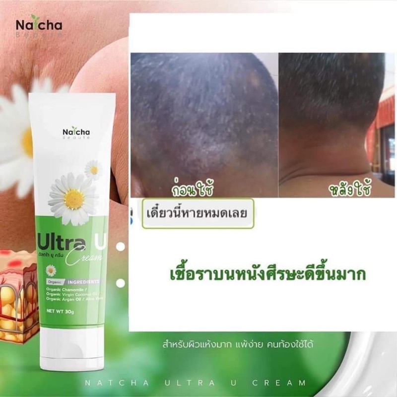 เซ็ท 6 หลอด แถมสบู่แก้เชื้อรา 1 ก้อน อัลตร้ายูครีม ของแท้ ส่งฟรี Natcha Ultra U Cream แก้เชื้อรา ...