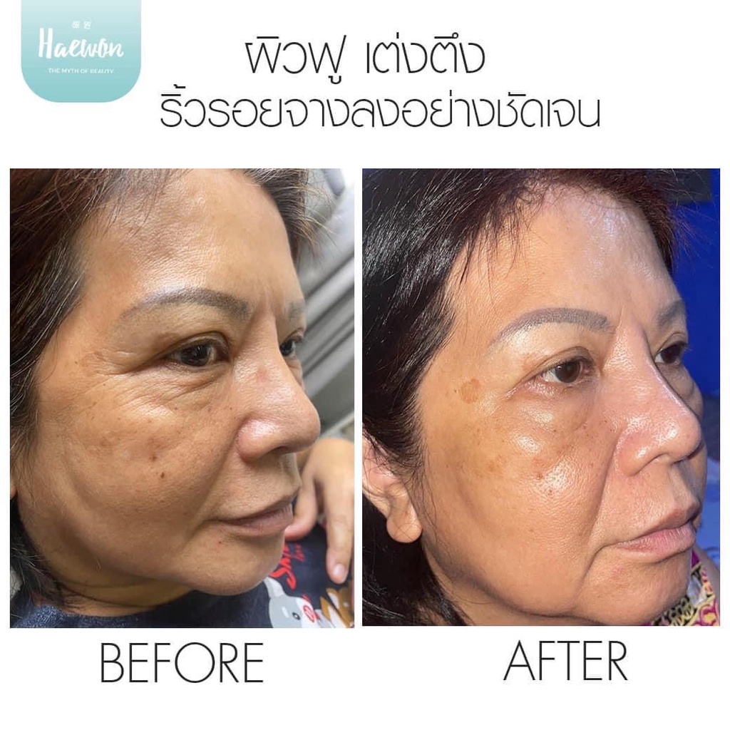 ของแท้ ส่งฟรี️ ฟิลเลอร์แบบทา Haewon Hya Filler แฮวอน ไฮยา ฟิลเลอร์ ขนาด ...