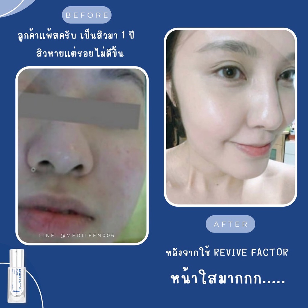 Medileen SETผิวคุณจุ๊บจิ๊บ ฟรีเทสเตอร์️สะสมคะแนน เมดิลีน ครีมหน้าใส ...