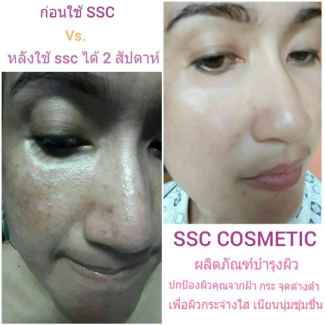 SSC Cosmetic มีของแถมครีมทาฝ้า Skin Melasma Cream 15 g. White Gold ...