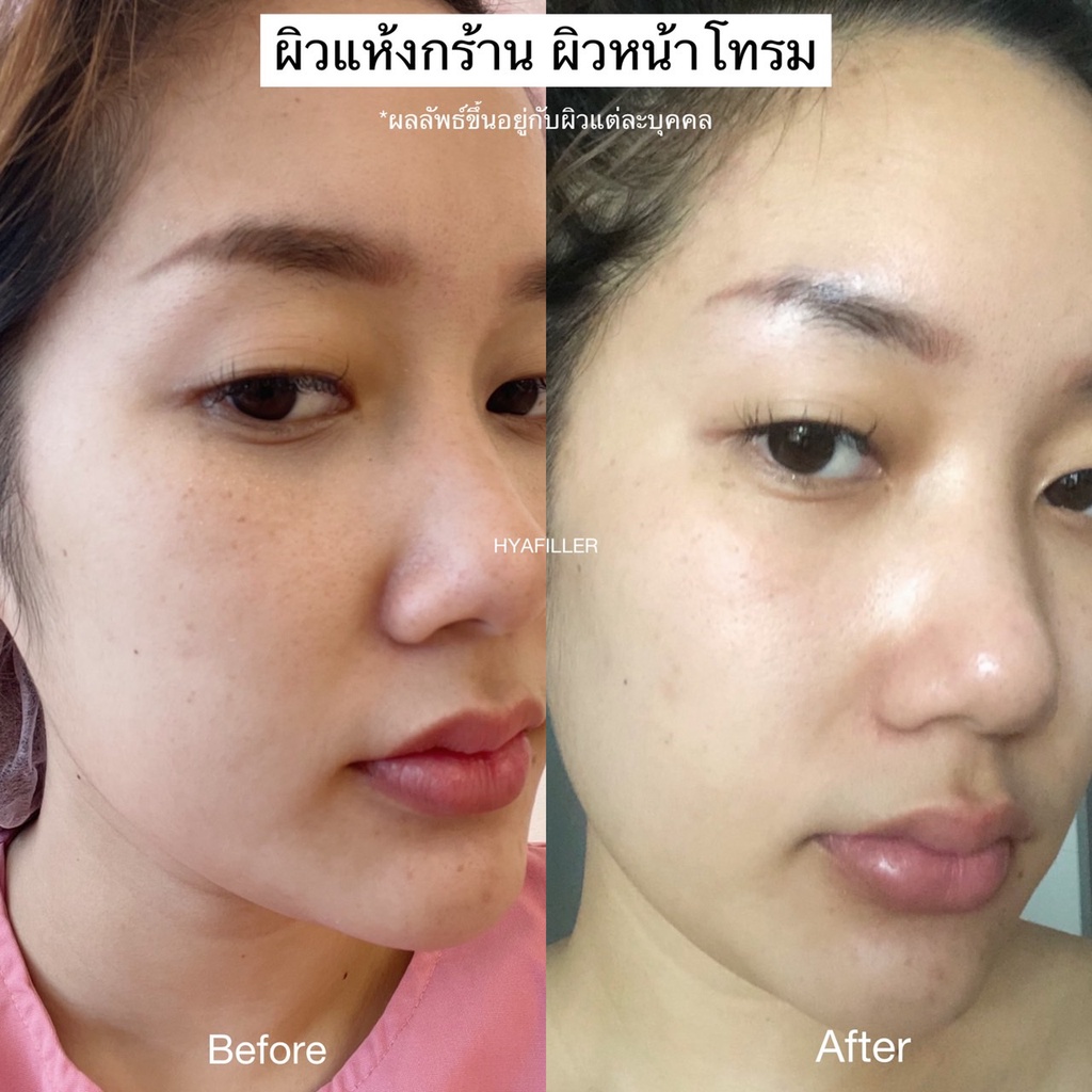 ของแท้ ส่งฟรี️ ฟิลเลอร์แบบทา Haewon Hya Filler แฮวอน ไฮยา ฟิลเลอร์ ขนาด ...