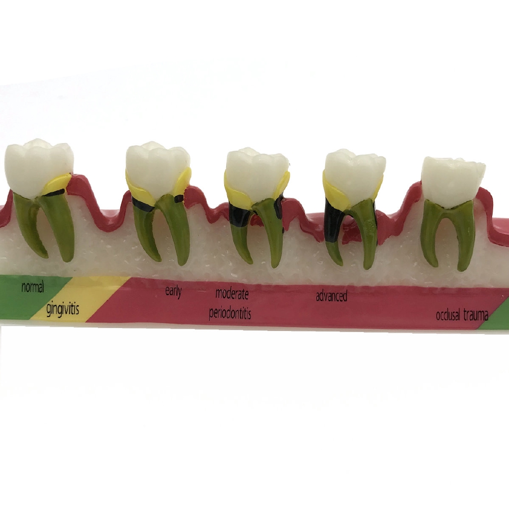 Dental Teeth Model Periodontal Disease Assort Tooth Classification ...