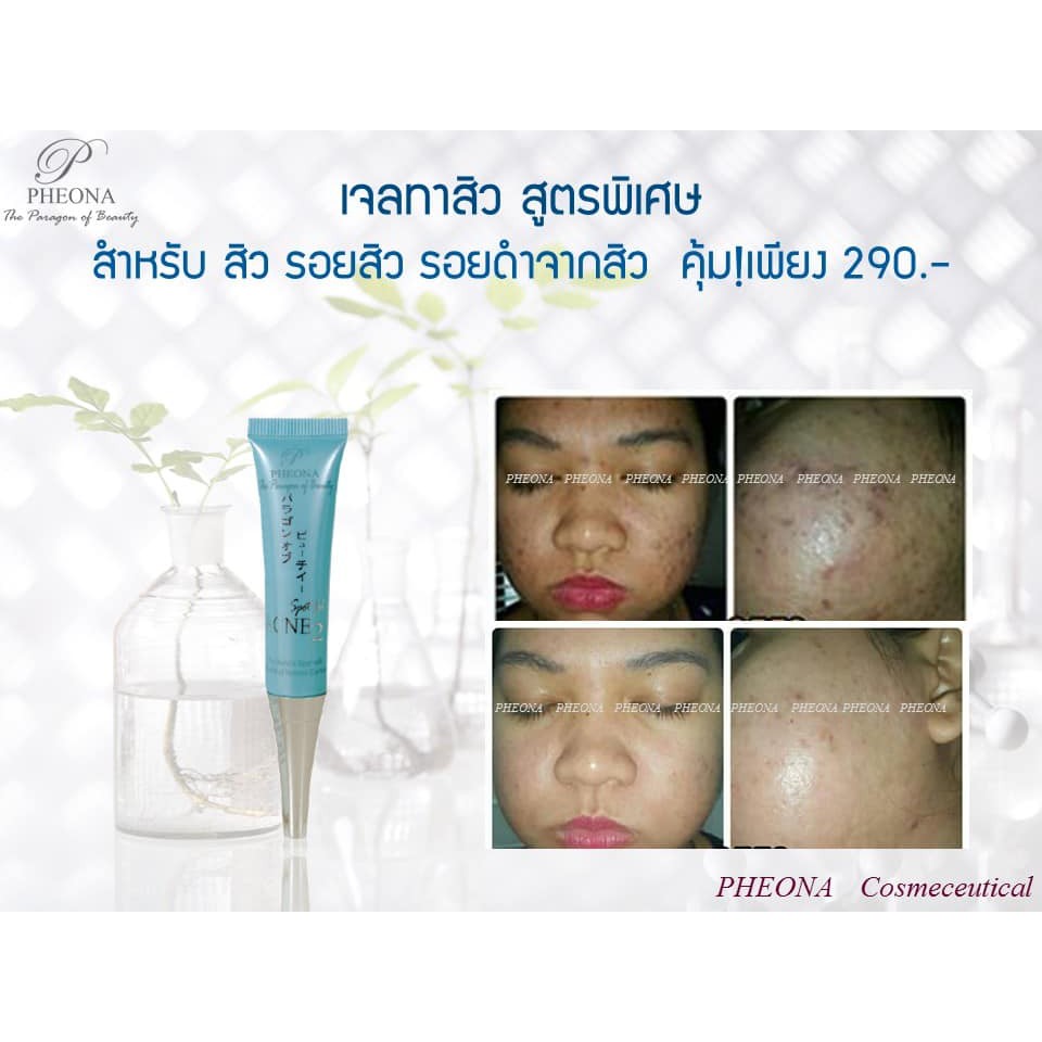 Pheona เจลแต้มสิว ลดหลุมสิว รอยสิว ANTI-ACNE GEL - pheonathailand ...