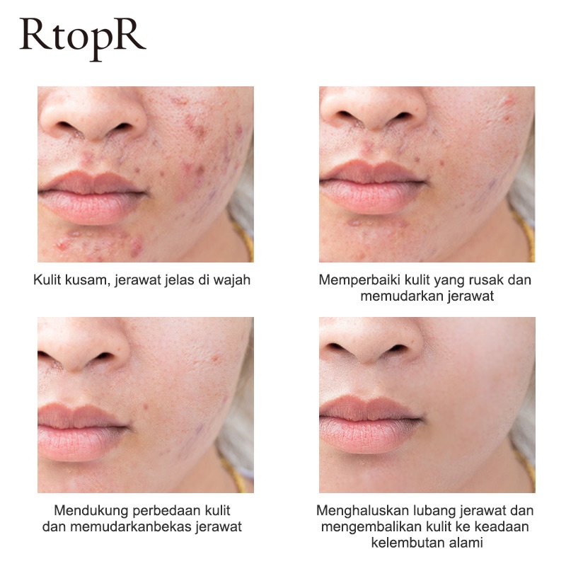 RtopR เซรั่มลดสิว เผยผิวกระจ่างใส บอกลาปัญหาสิว สูตรช่วยลดสิวและควบคุม ...