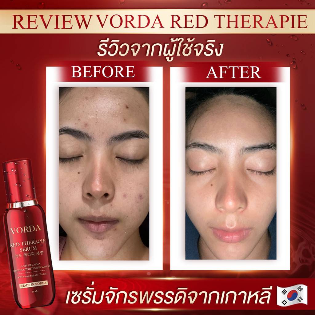 1 แถม 1 Vorda RedTherapie Serum️เซรั่มดิวอริสรา นำเข้าจากเกาหลี หน้าใส ลดเลือนฝ้า กระ จุดด่างดำ ...