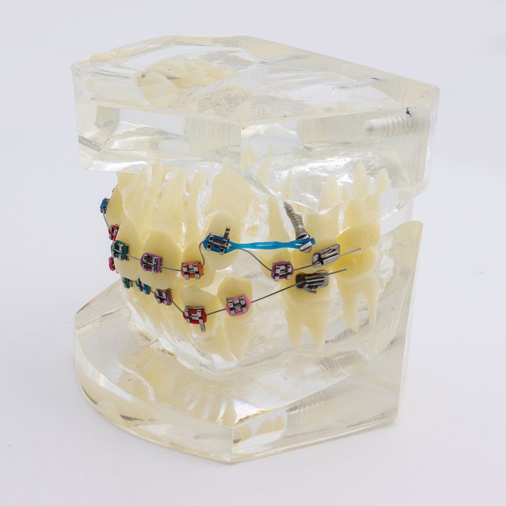 ทันตกรรมการจัดฟัน Dental Standard Orthodontic Teeth Model with Brackets ...
