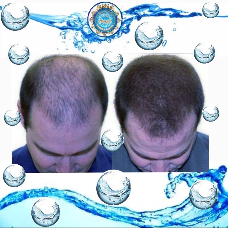 Finasteride1mg harifinแฮริฟิน 1 mg. 1 กล่อง 30 เม็ด - popup99 - ThaiPick