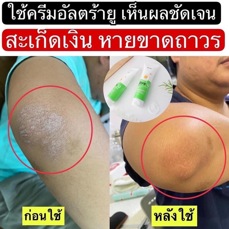 อัลตร้ายูครีม เซ็ท 3 หลอด ของแท้ ส่งฟรี Natcha Ultra U Cream - phaniddashop - ThaiPick