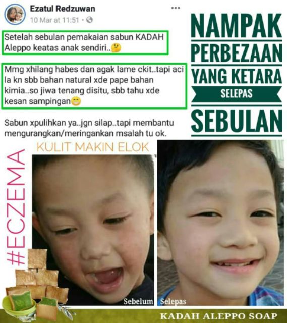 Aleppo Soap ~ Face / Hair / Body Soap ~ According To Eczema, Acne, Ruam ...