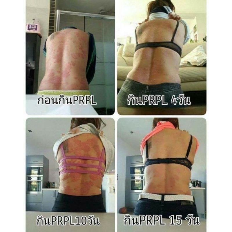 ถูกที่สุดส่งฟรีPRPL CAPXเพอเพิลแคปเอ็กซ์ อาหารเสริมฟื้นฟูเซลล์ ️ของแท้100ไม่แท้คืนเงิน ...