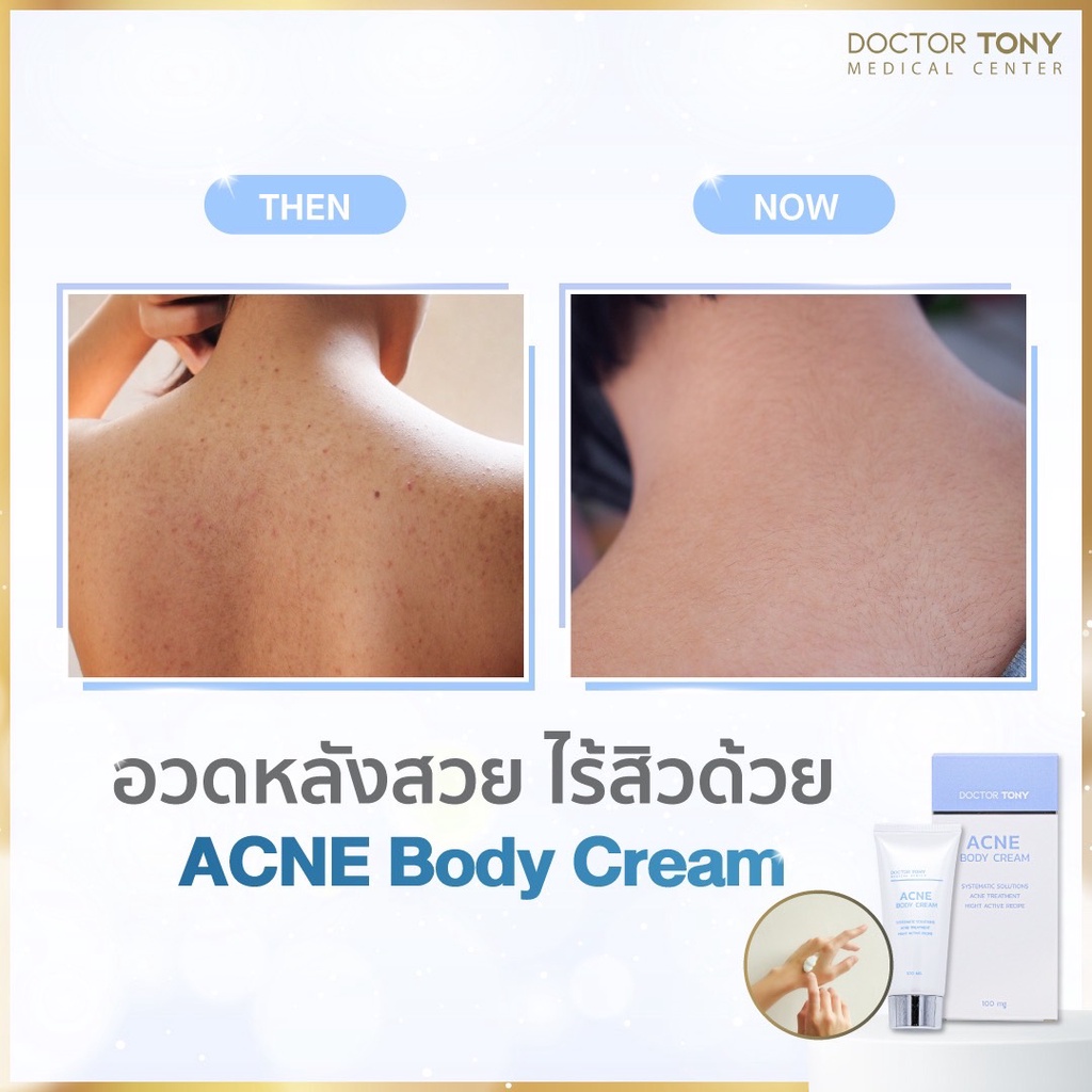Doctor Tony Acne Body Cream 100ml. โลชั่น ลดสิว ลดสิวที่หลัง หน้าอก ขน ...