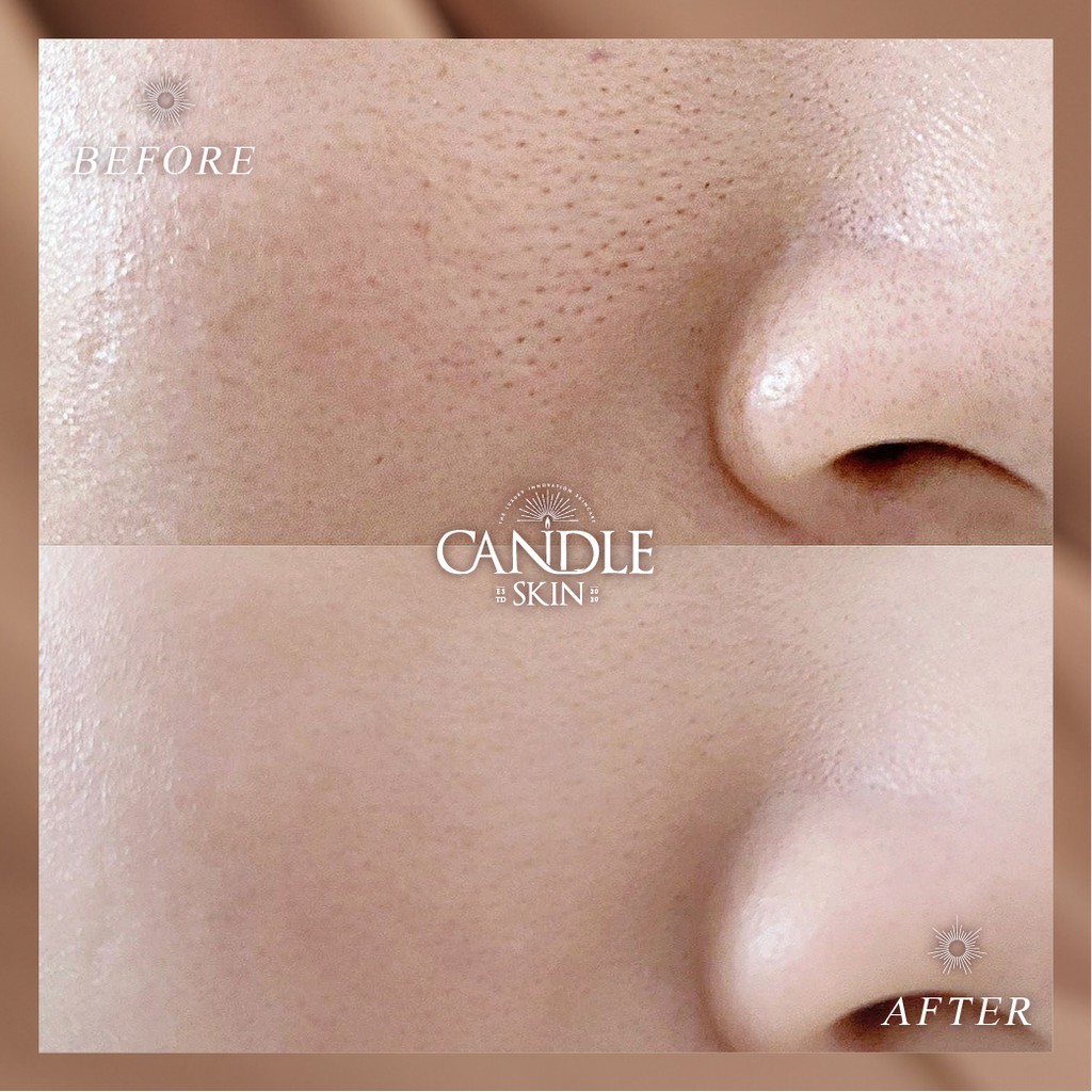 Candle Skin แคนเดิลสคินส์ ( So Deep HYA Luigi ) ยกกระชับรูขมขน ลดเลือน ...