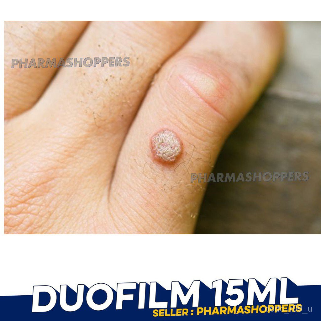 Fhbp DUOFILM 15ml - Ketuat dan Kutil - Remove Plantar Wart,Corn and ...