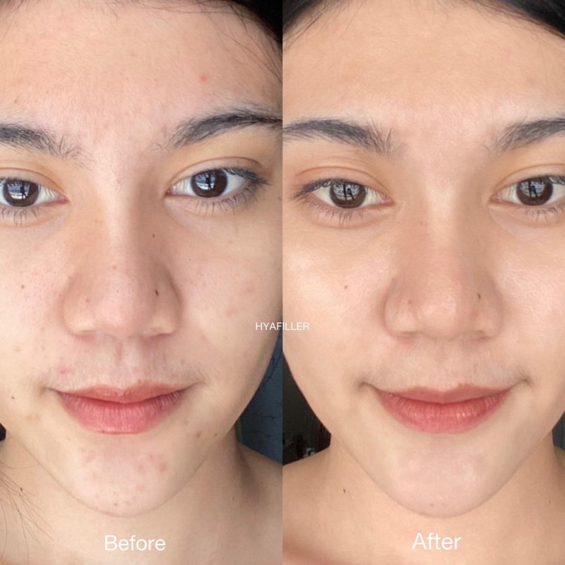 ส่งฟรี มีปลายทาง HAEWON HYA Filler เซรั่มไฮยาลูรอนเข้มข้น 15ml ไฮยา ฟิล ...