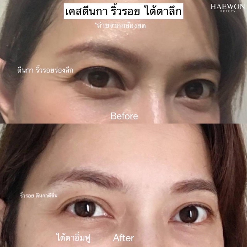 ส่งฟรี มีปลายทาง HAEWON HYA Filler เซรั่มไฮยาลูรอนเข้มข้น 15ml ไฮยา ฟิล ...