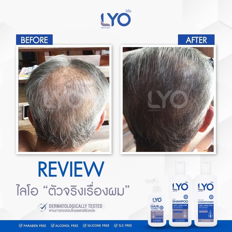 โปร 1 แถม 4 ส่งฟรี LYO Hair tonic หนุ่ม กรรชัย ผลิตภัณฑ์ดูแลผม แชมพู ลด ...