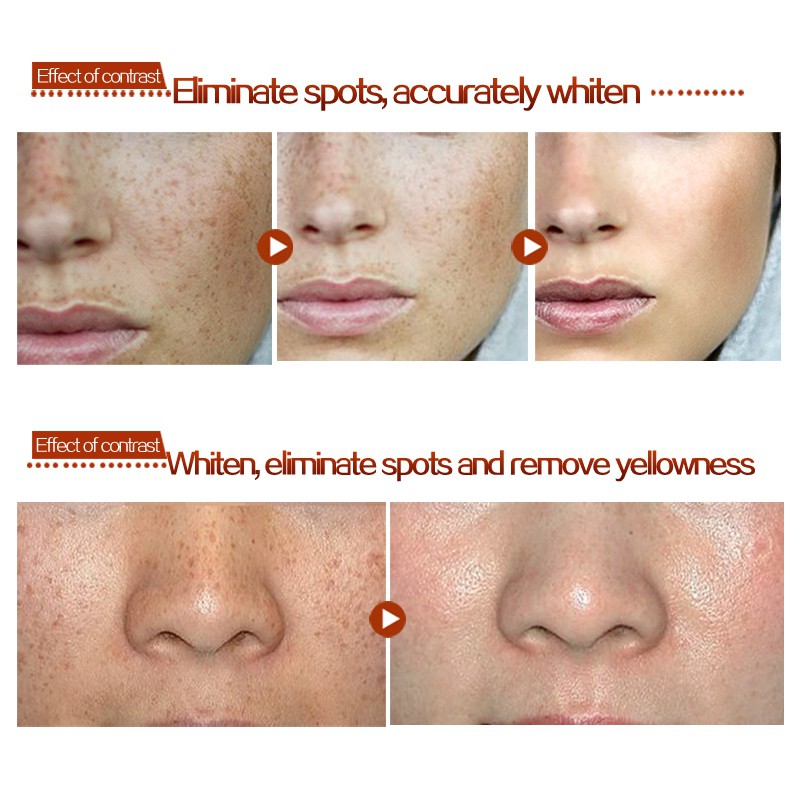 Meiking Lightening Blemish Removal Serum Reduces Freckles Face Cream ...