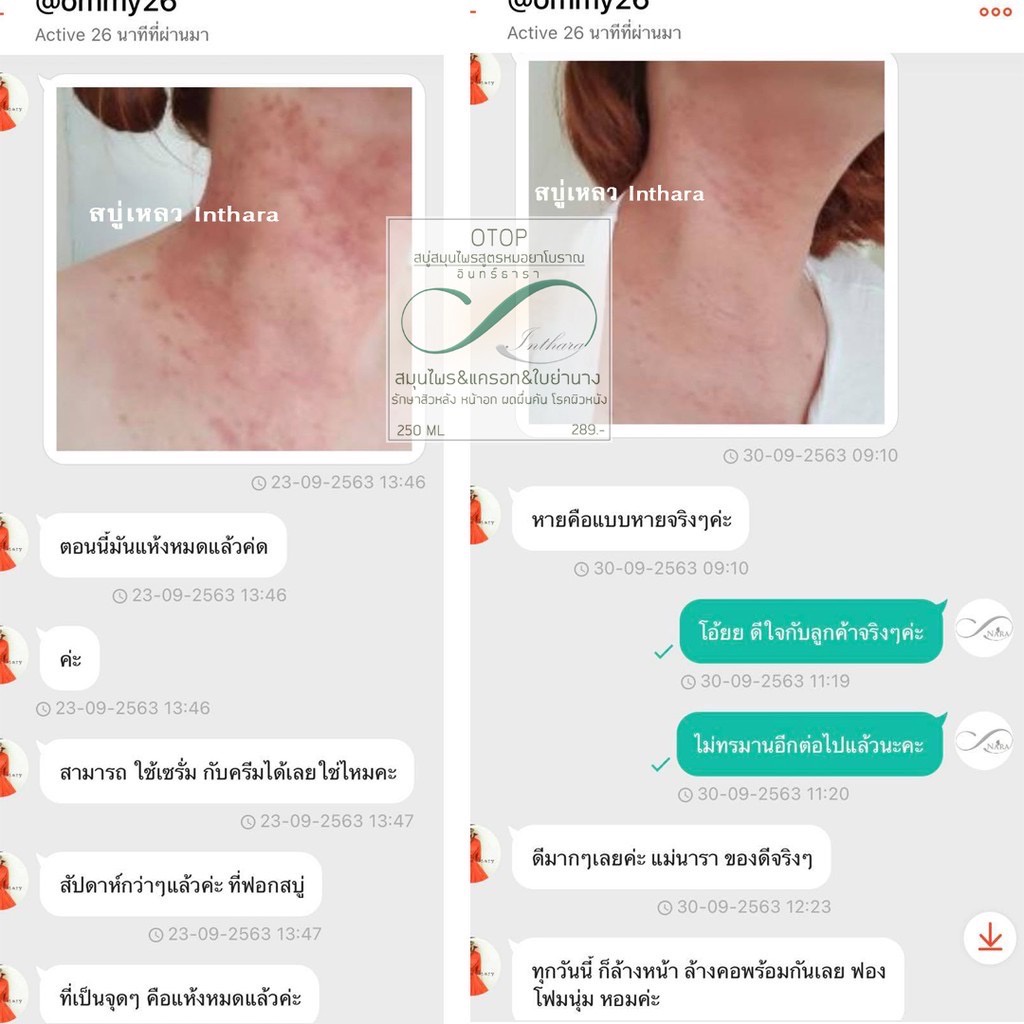 สบู่เหลวสูตรหมอ-ยาโบราณ รักษาสิวหลัง-หน้าอก ผดผื่นคันตามร่างกายสมุนไพร ...