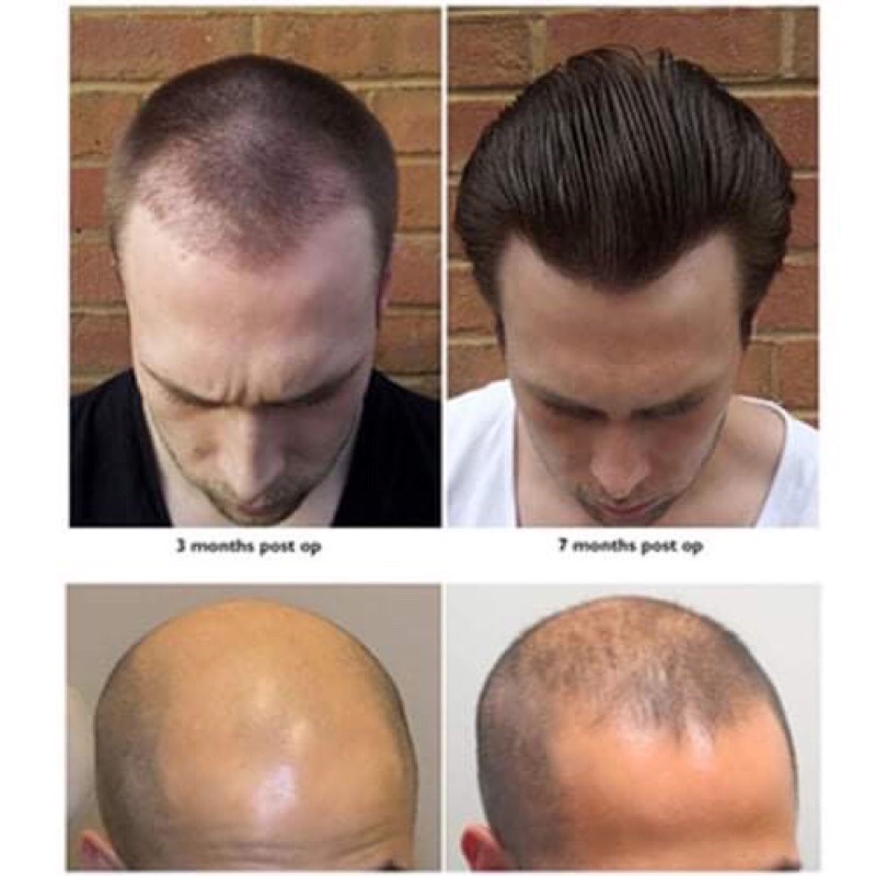 Minox5 Minxcidil 5 mg. 100 เม็ด หยุดผมร่วง ปลูกผมใหม่ให้แข้งแรง - mar ...