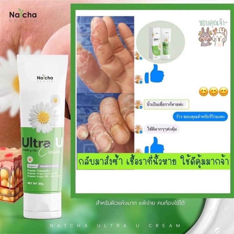 เซ็ท 6 หลอด แถมสบู่แก้เชื้อรา 1 ก้อน อัลตร้ายูครีม ของแท้ ส่งฟรี Natcha Ultra U Cream แก้เชื้อรา ...